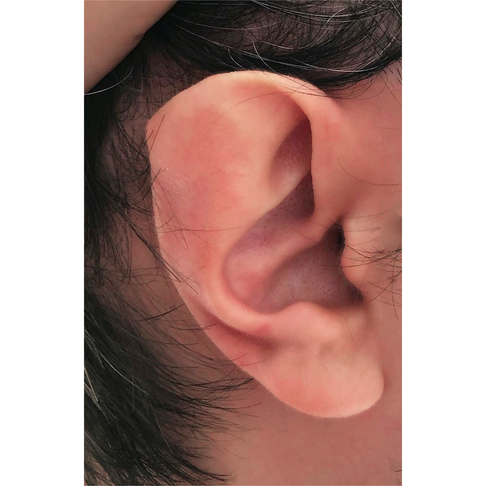 Kulakta heliks kıvrımı problemlerinin onarımı | Defne Erkara